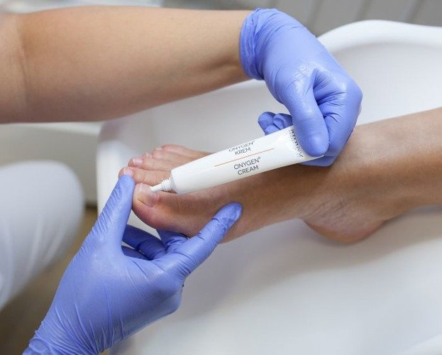 ONYGEN® CREAM skuteczny krem na onycholizę